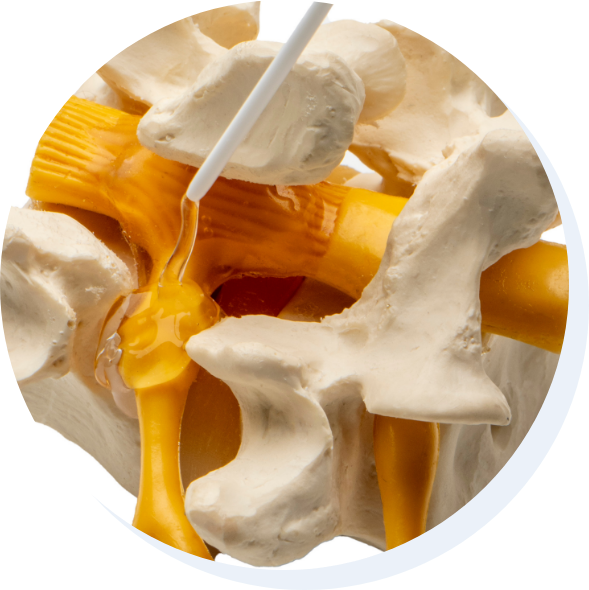 Fziomed | Reduce Post-Surgical Adhesions | Spine Surgery